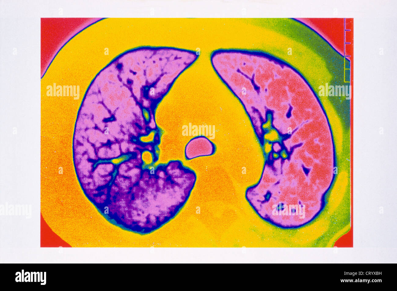 LUNG SCAN FOR EMPHYSEMA Stock Photo - Alamy