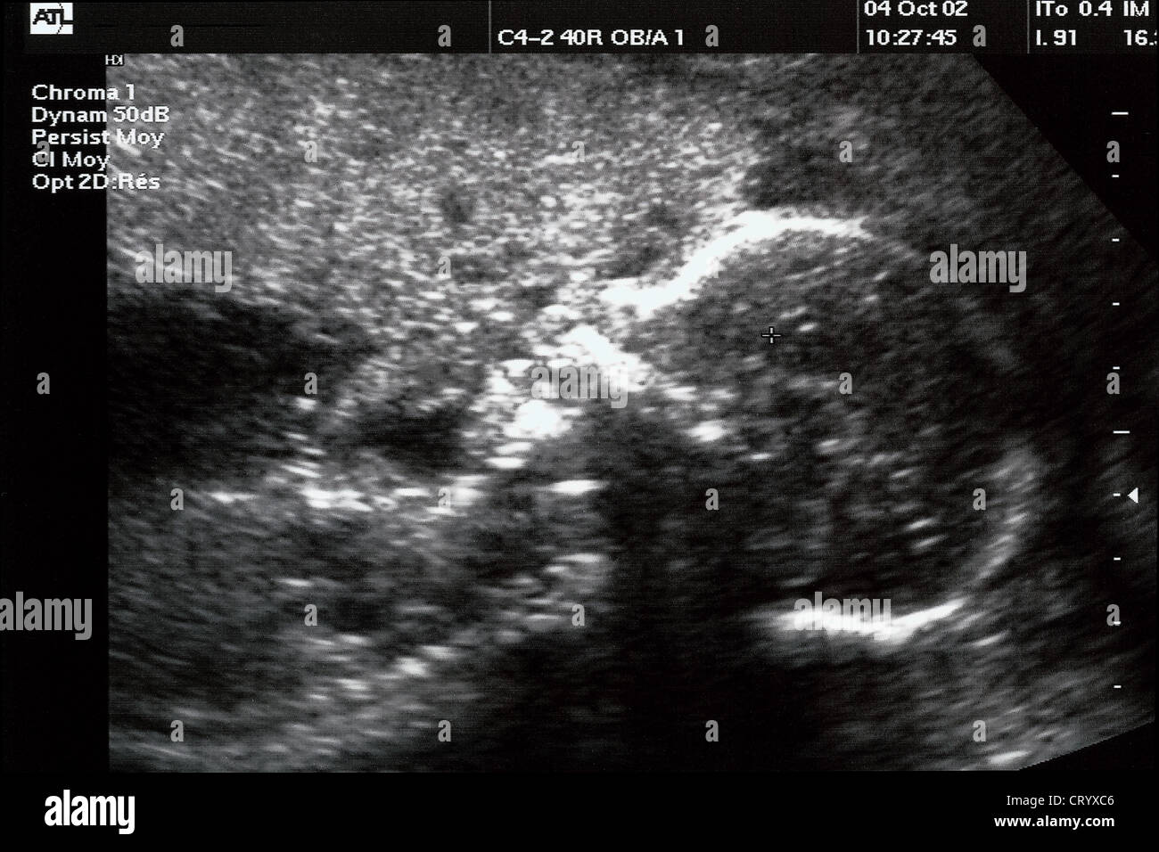 5 month ultrasound hi-res stock photography and images - Alamy