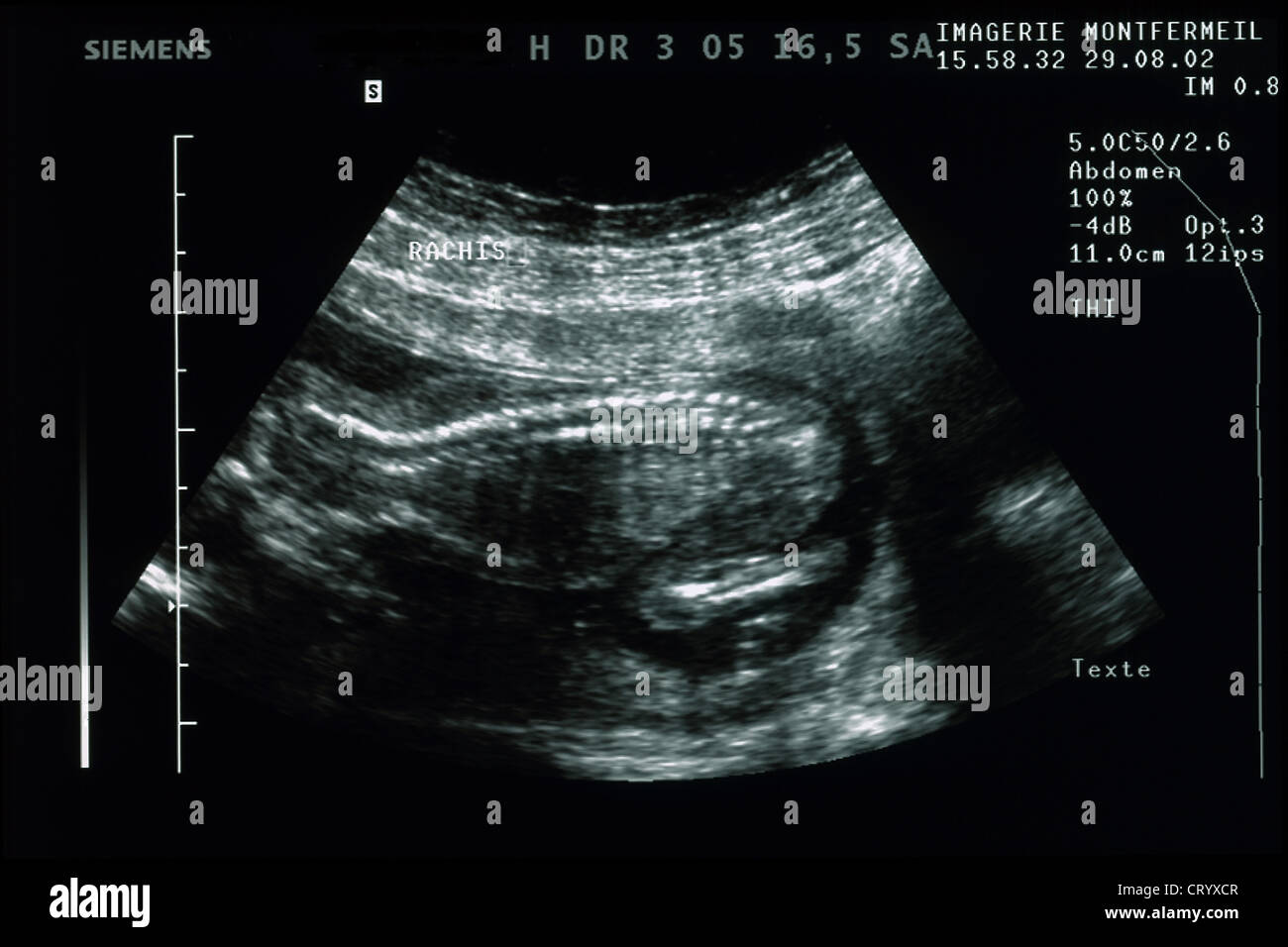 Sonogram fetus 16 weeks hi-res stock photography and images - Alamy