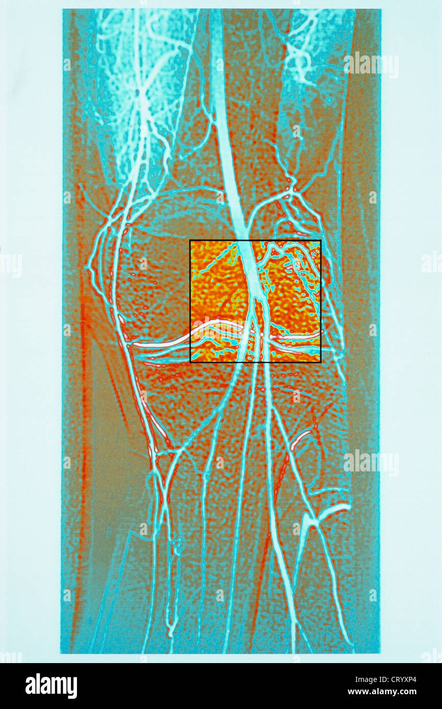 POPLIT. ARTER. THROMBOSIS, ANG Stock Photo - Alamy