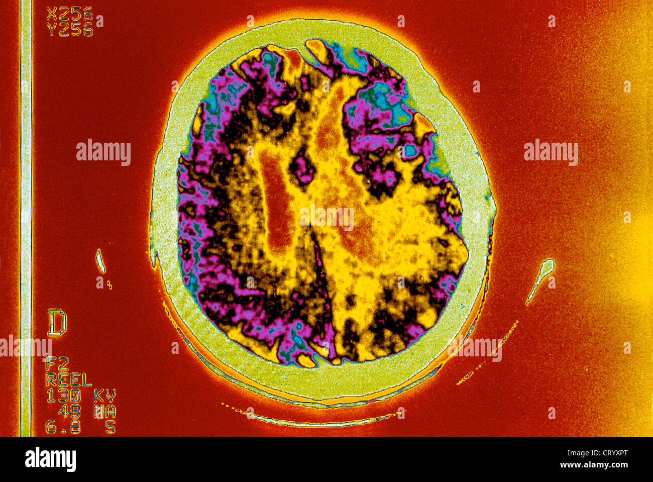 HEMORRHAGE, BRAIN SCAN Stock Photo - Alamy