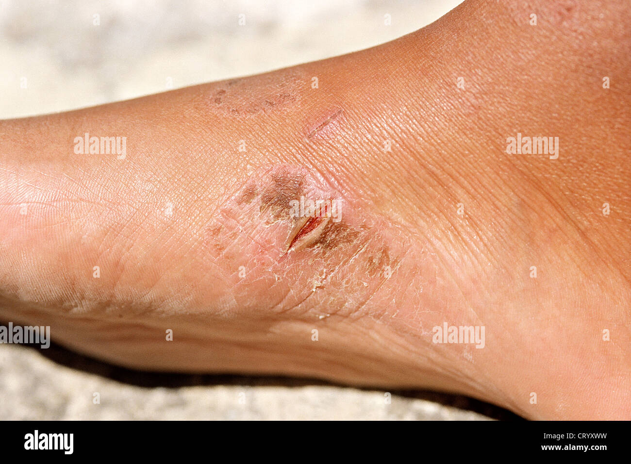 Feet sores hi-res stock photography and images - Alamy
