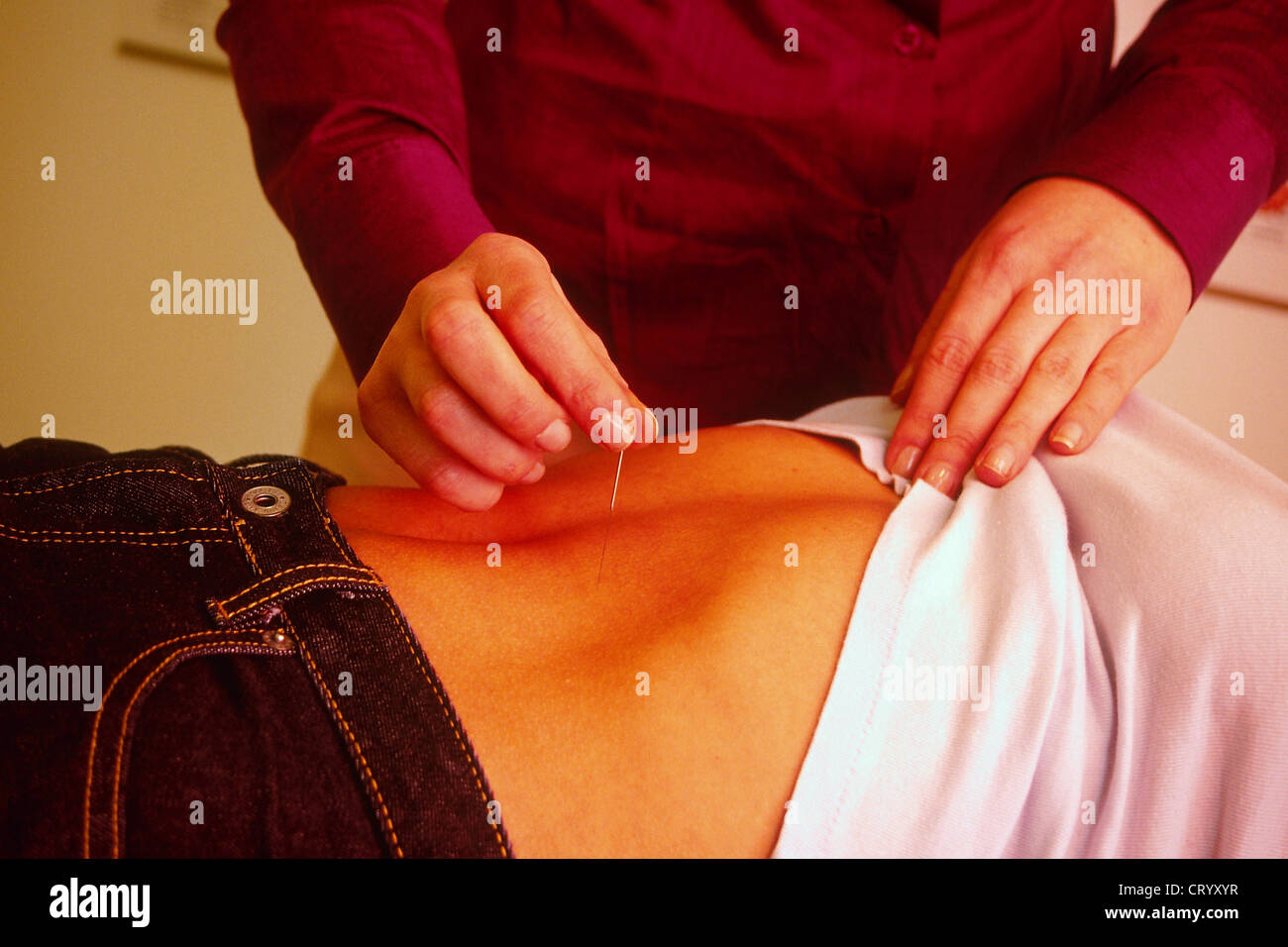 Acupuncture woman belly hi-res stock photography and images - Alamy
