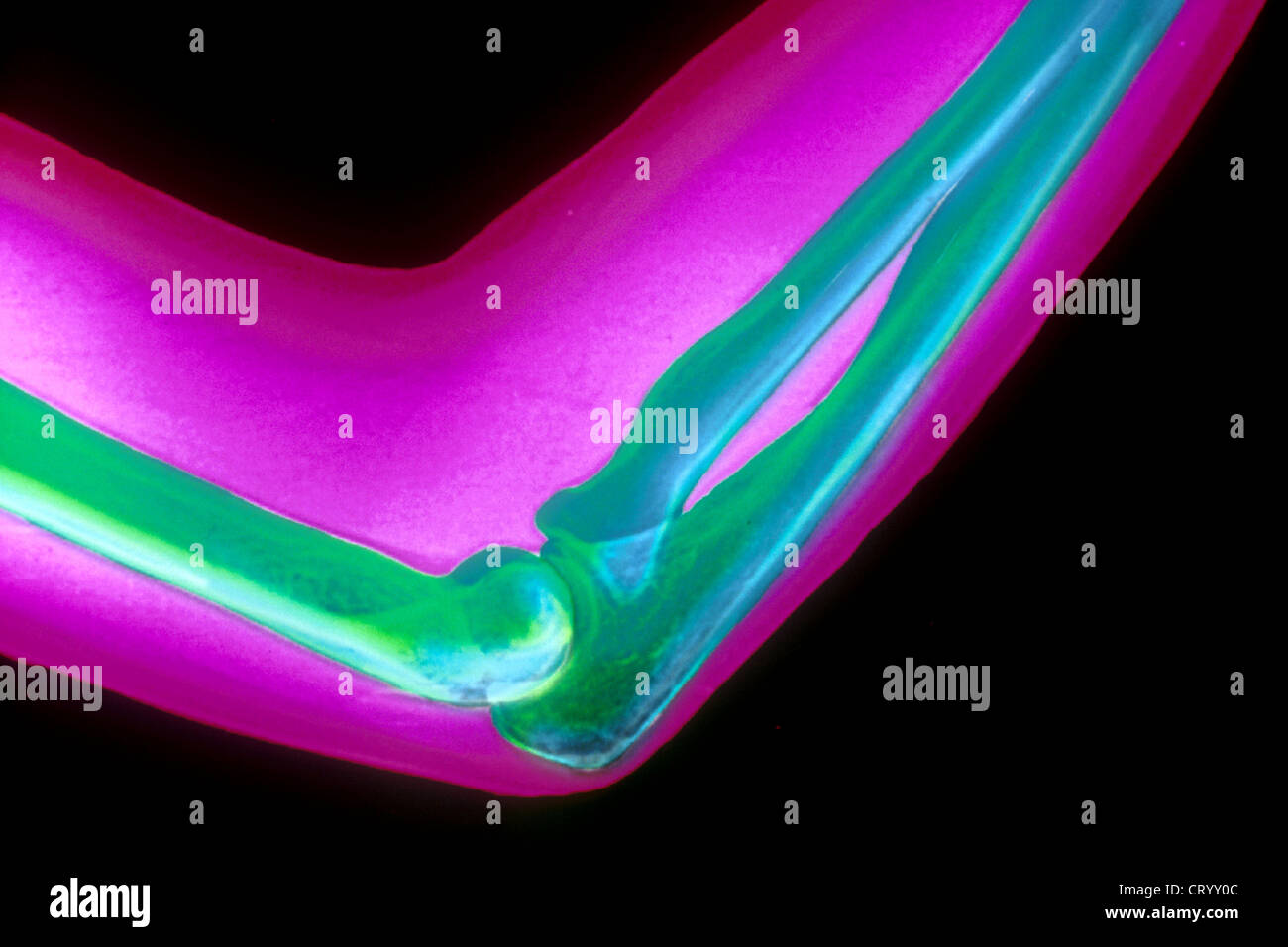 X ray elbows hi-res stock photography and images - Alamy