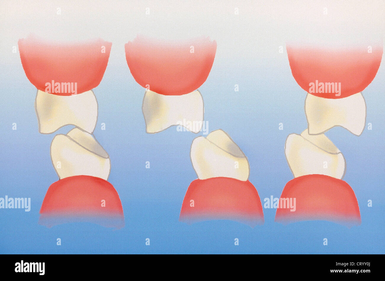 Malposition hi-res stock photography and images - Alamy