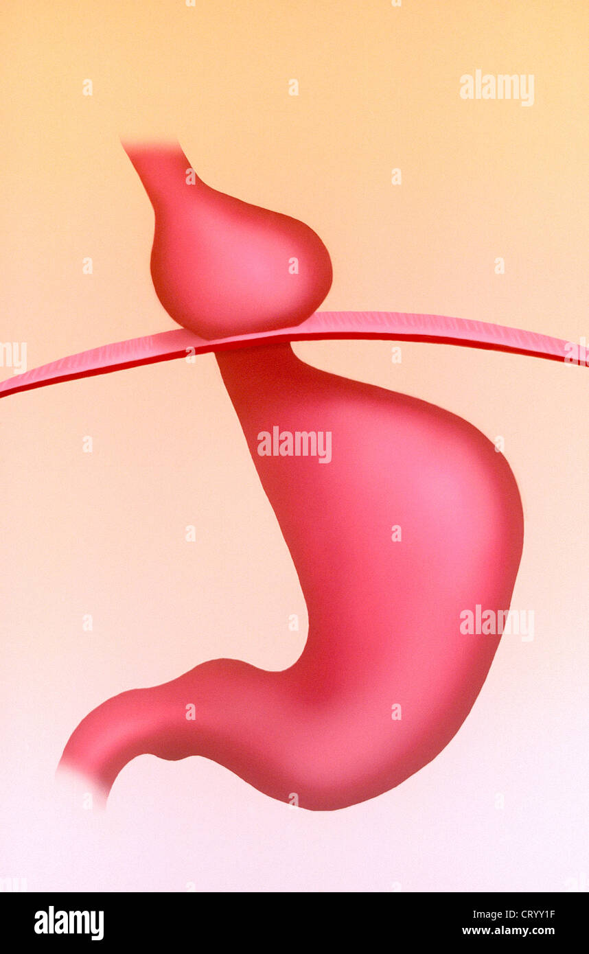 Hiatal hernia hi-res stock photography and images - Alamy