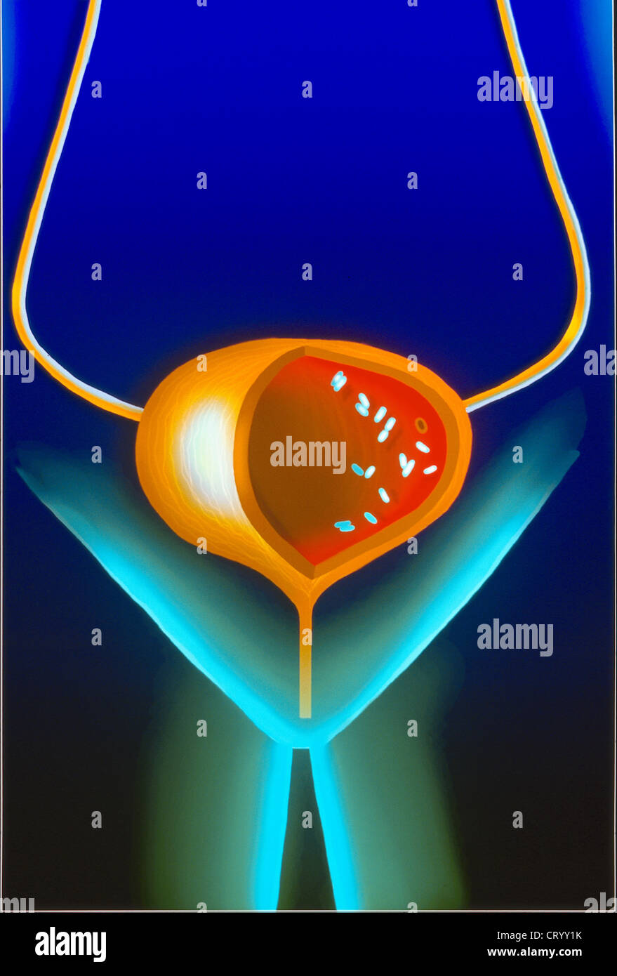 Cystitis drawing hi-res stock photography and images - Alamy
