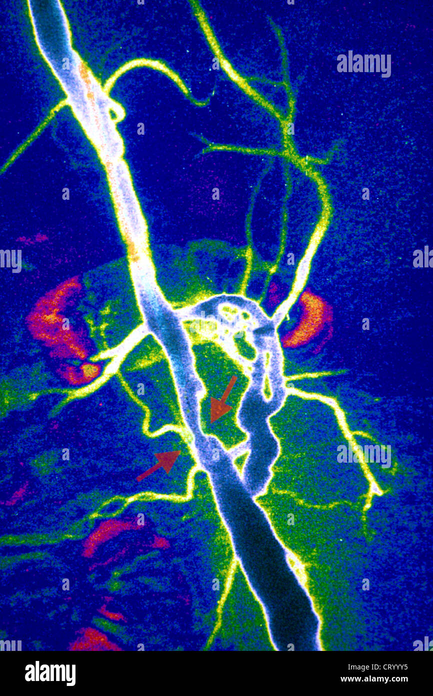 ARTERIAL ANGIOPLASTY, RESULT Stock Photo - Alamy ARTERIAL ANGIOPLASTY, RESULT Stock Photo - Alamy