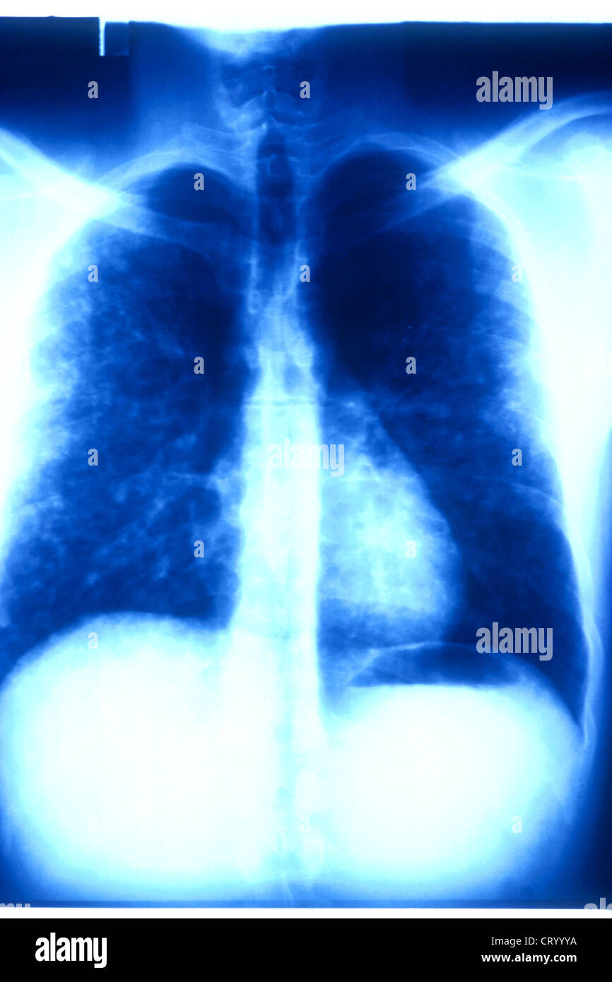 FIBROSIS OF THE LUNG, X-RAY Stock Photo - Alamy