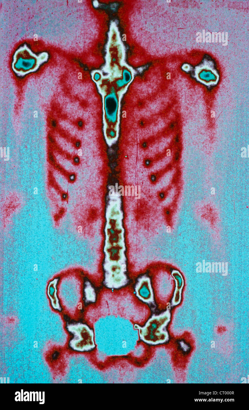 Osteitis hi-res stock photography and images - Alamy