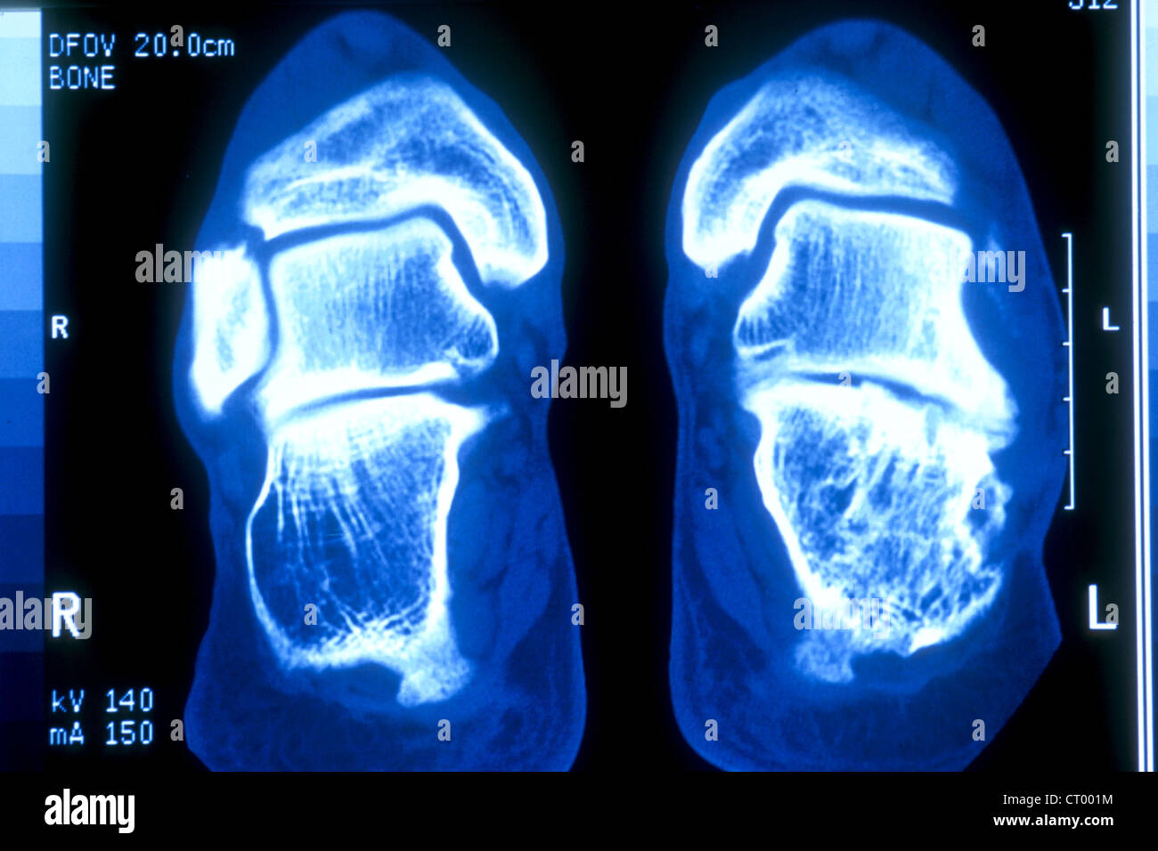 ANKLE OSTEOARTHRITIS, SCAN Stock Photo - Alamy