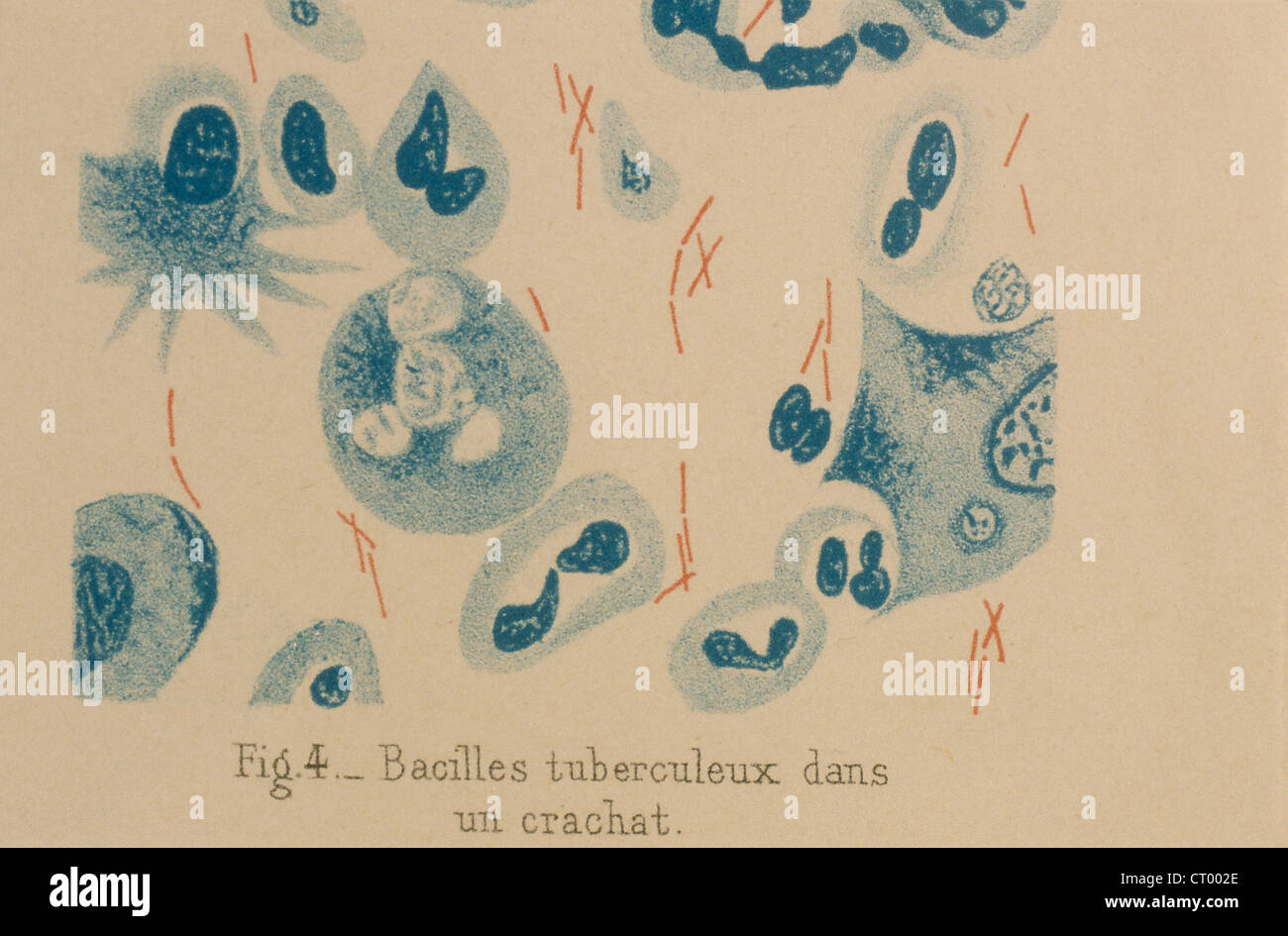 Tuberculosis drawing hi-res stock photography and images - Alamy