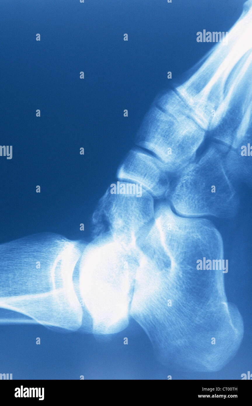 Fractured ankle bones hi-res stock photography and images - Alamy