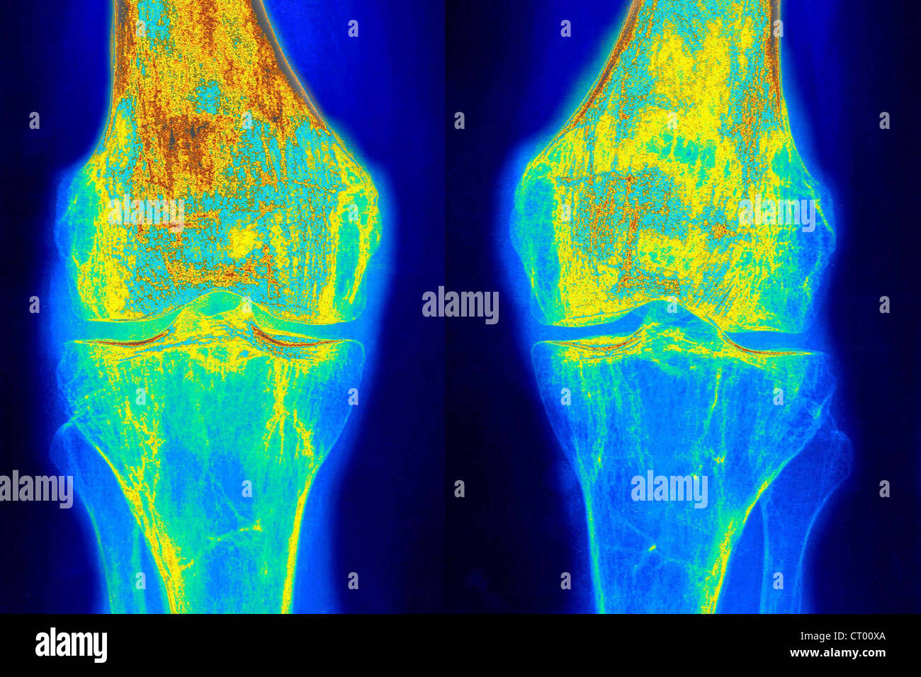 Osteoporosis photos hi-res stock photography and images - Alamy