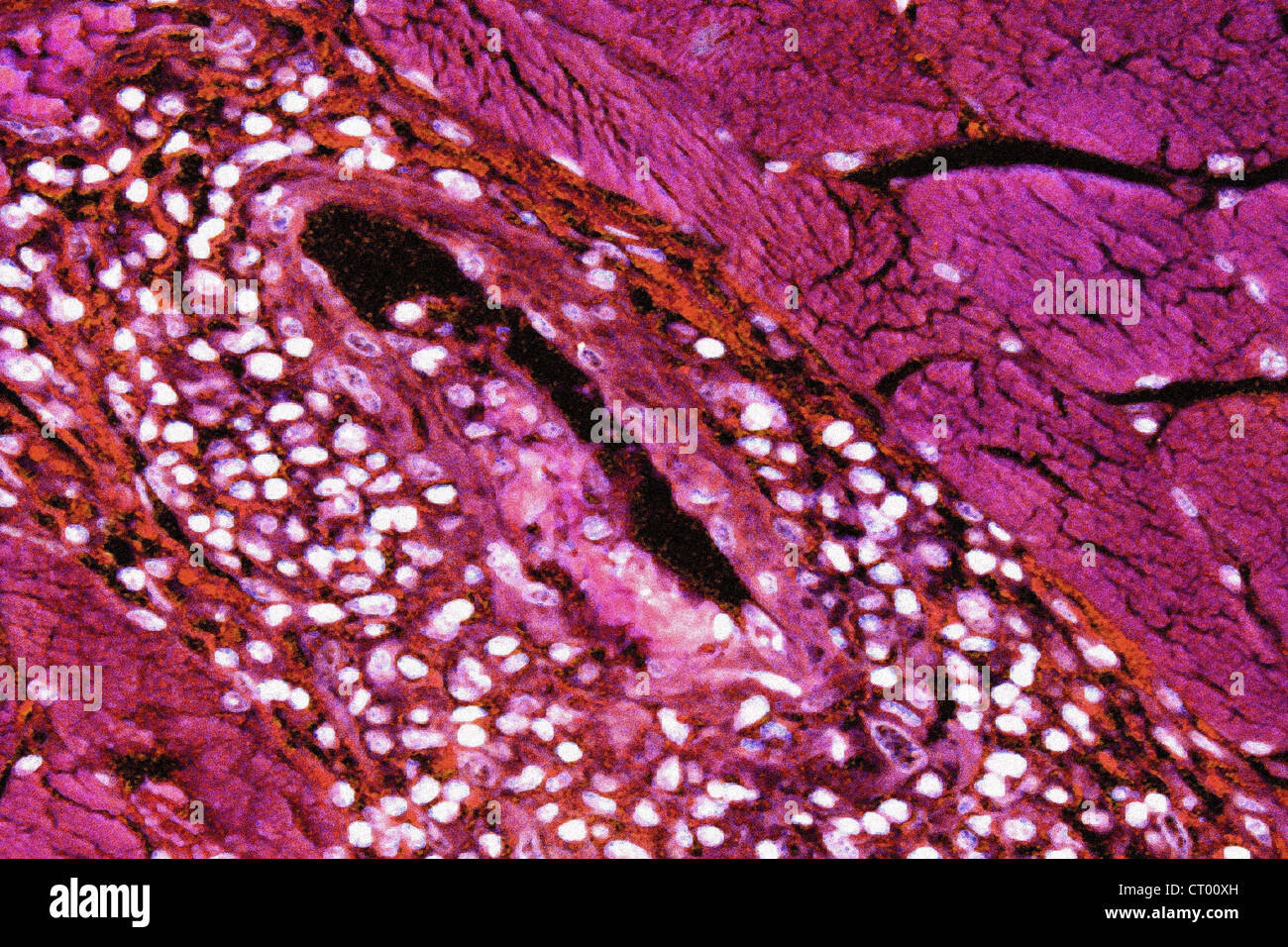 Periarteritis hi-res stock photography and images - Alamy