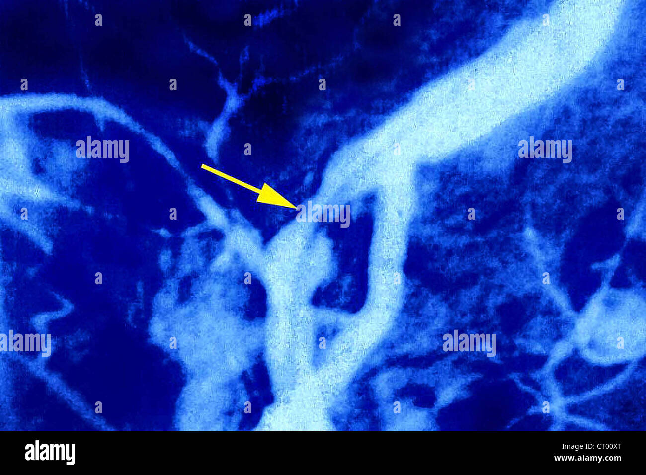 ARTERIAL STENOSIS, ANGIOGRAPHY Stock Photo - Alamy