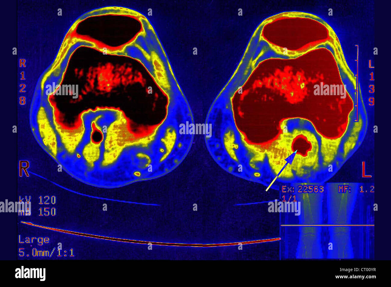 ANEURYSM POPLITEAL ARTERY Stock Photo - Alamy