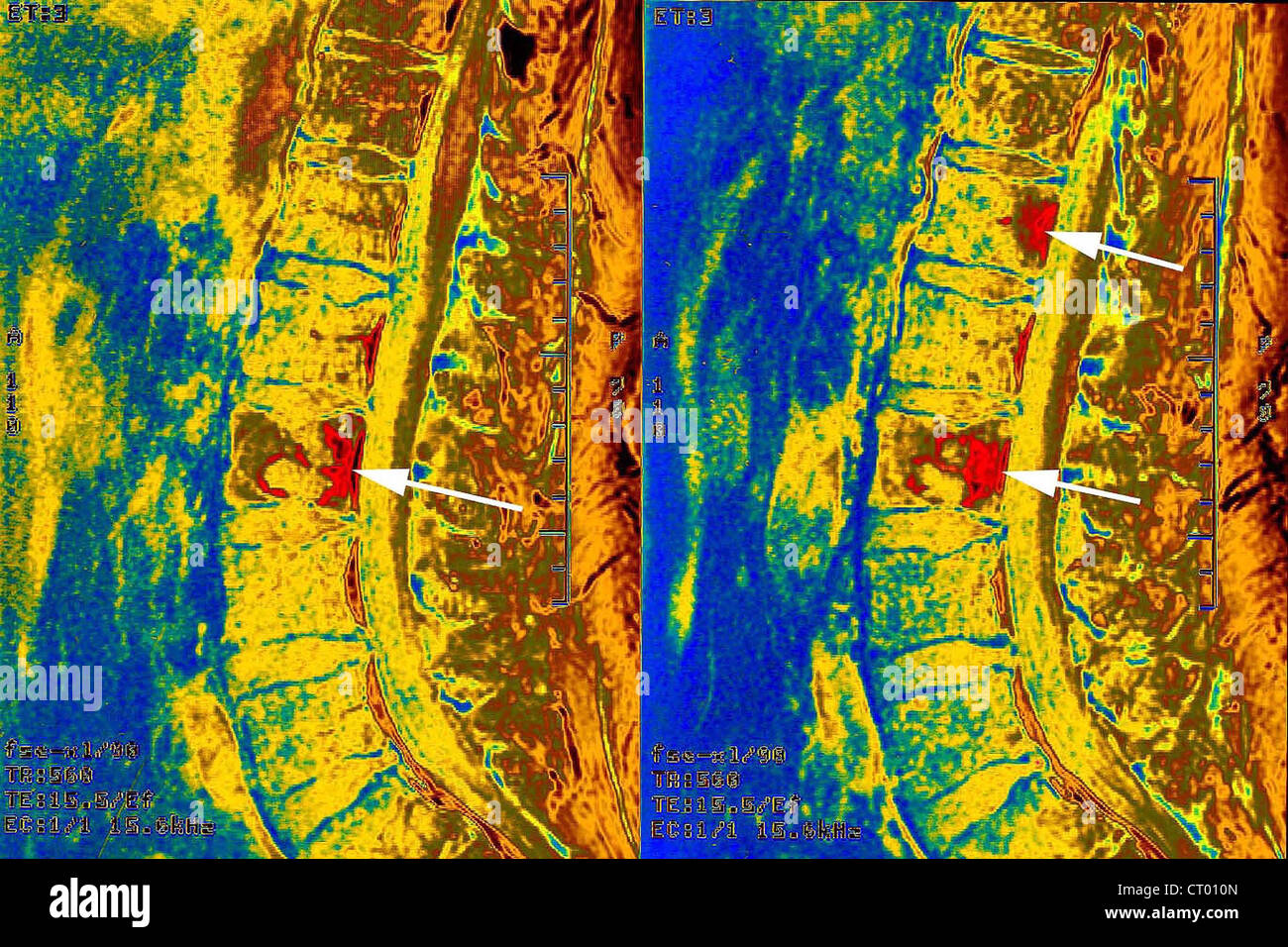 Osteitis hi-res stock photography and images - Alamy