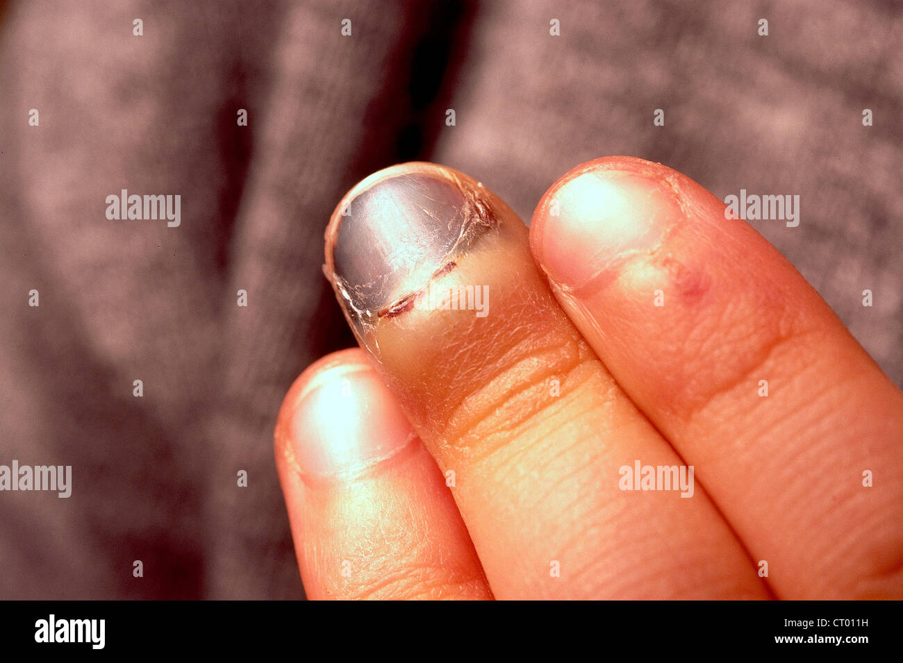Nail hematoma hi-res stock photography and images - Alamy