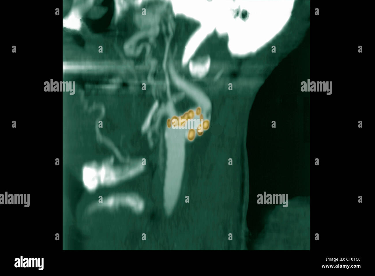 Blood vessel calcification hi-res stock photography and images - Alamy