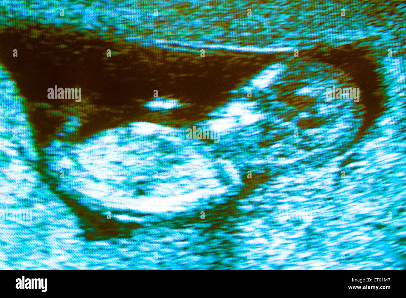 ULTRASOUND BIOMETRY OF THE FETUS Stock Photo - Alamy
