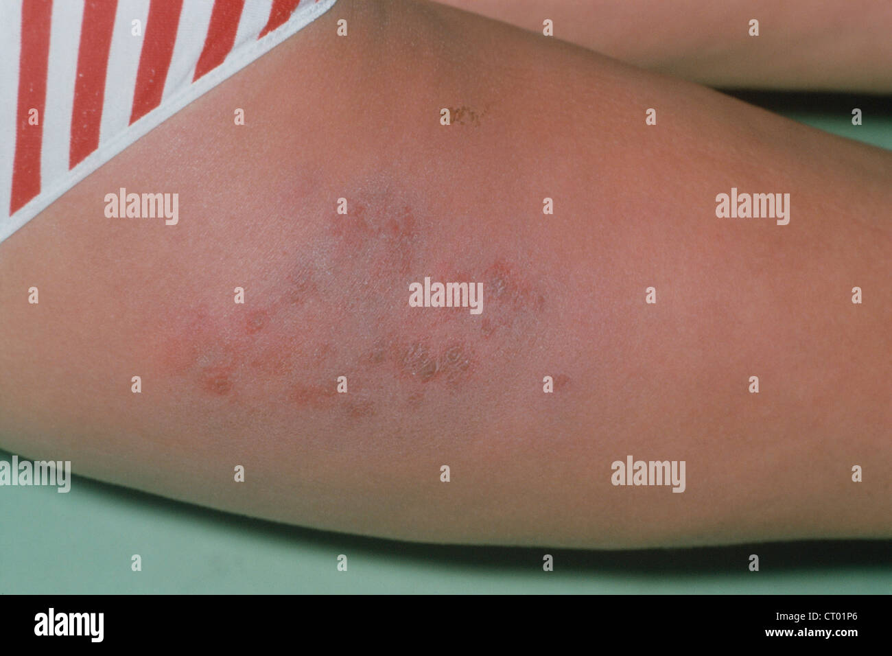 Chilblains hi-res stock photography and images - Alamy