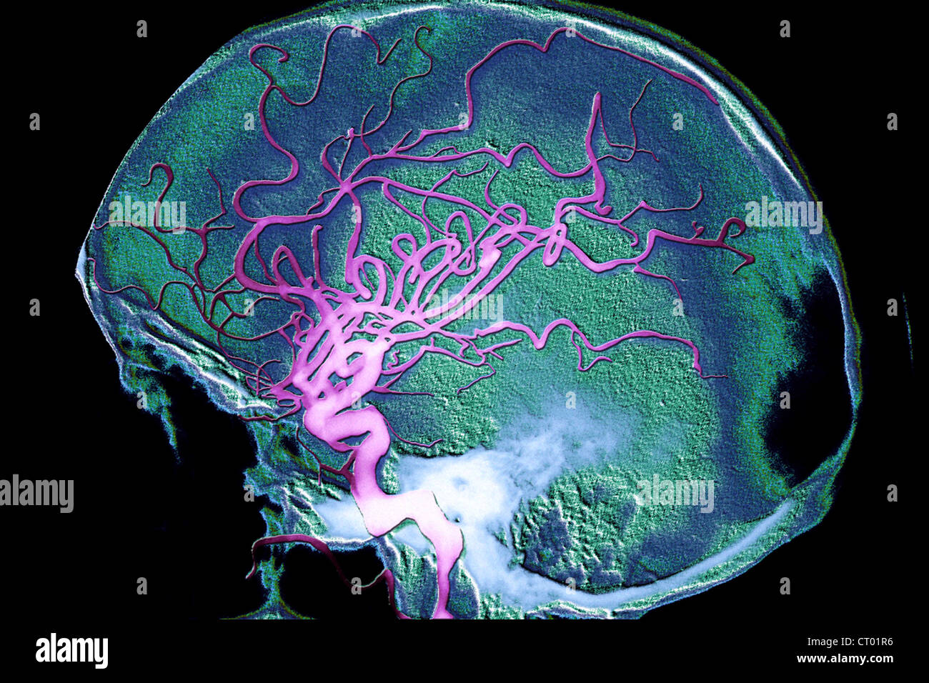 Cerebral arteriography hi-res stock photography and images - Alamy