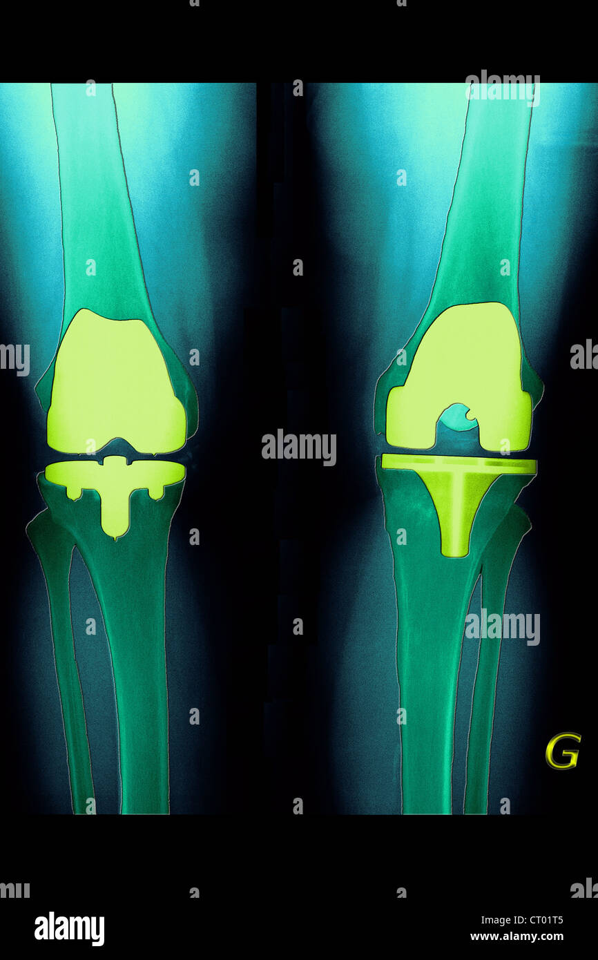 Knee replacements hi-res stock photography and images - Alamy