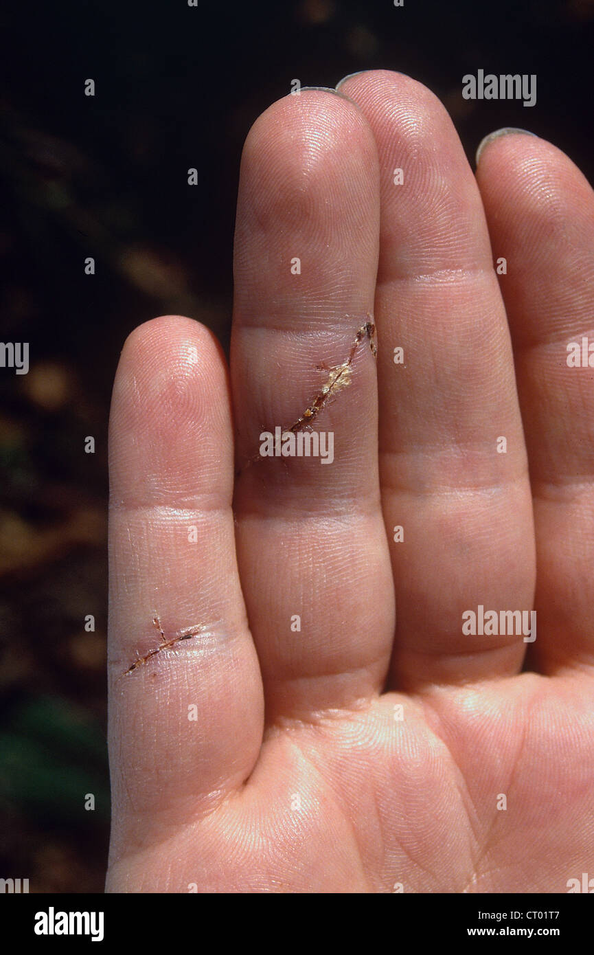 Postoperative trauma hi-res stock photography and images - Alamy