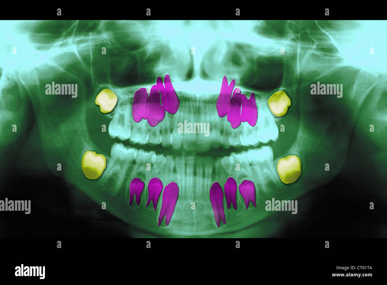 CHILD TOOTH, X-RAY Stock Photo - Alamy
