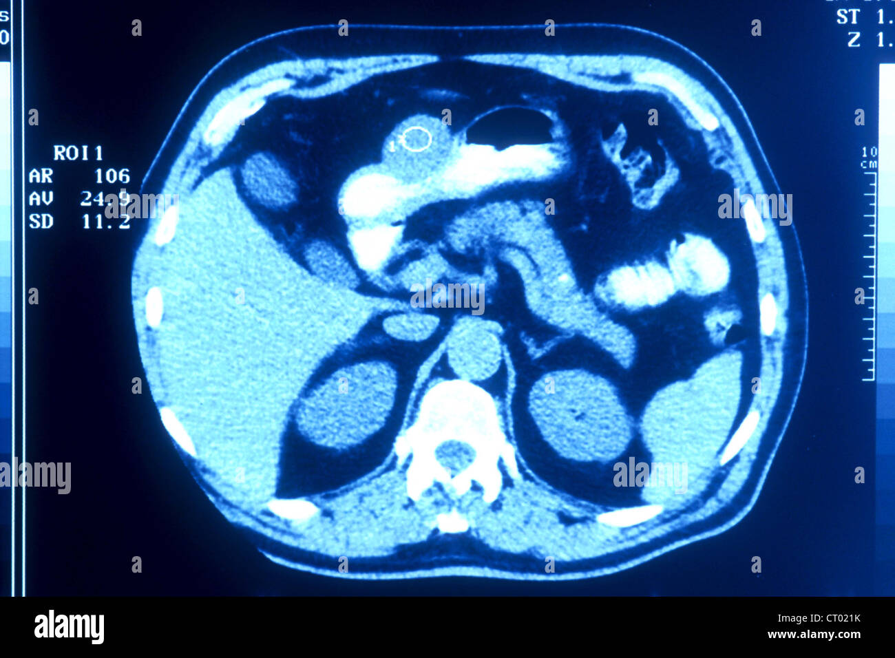 CANCER OF THE INTESTINE, SCAN Stock Photo - Alamy