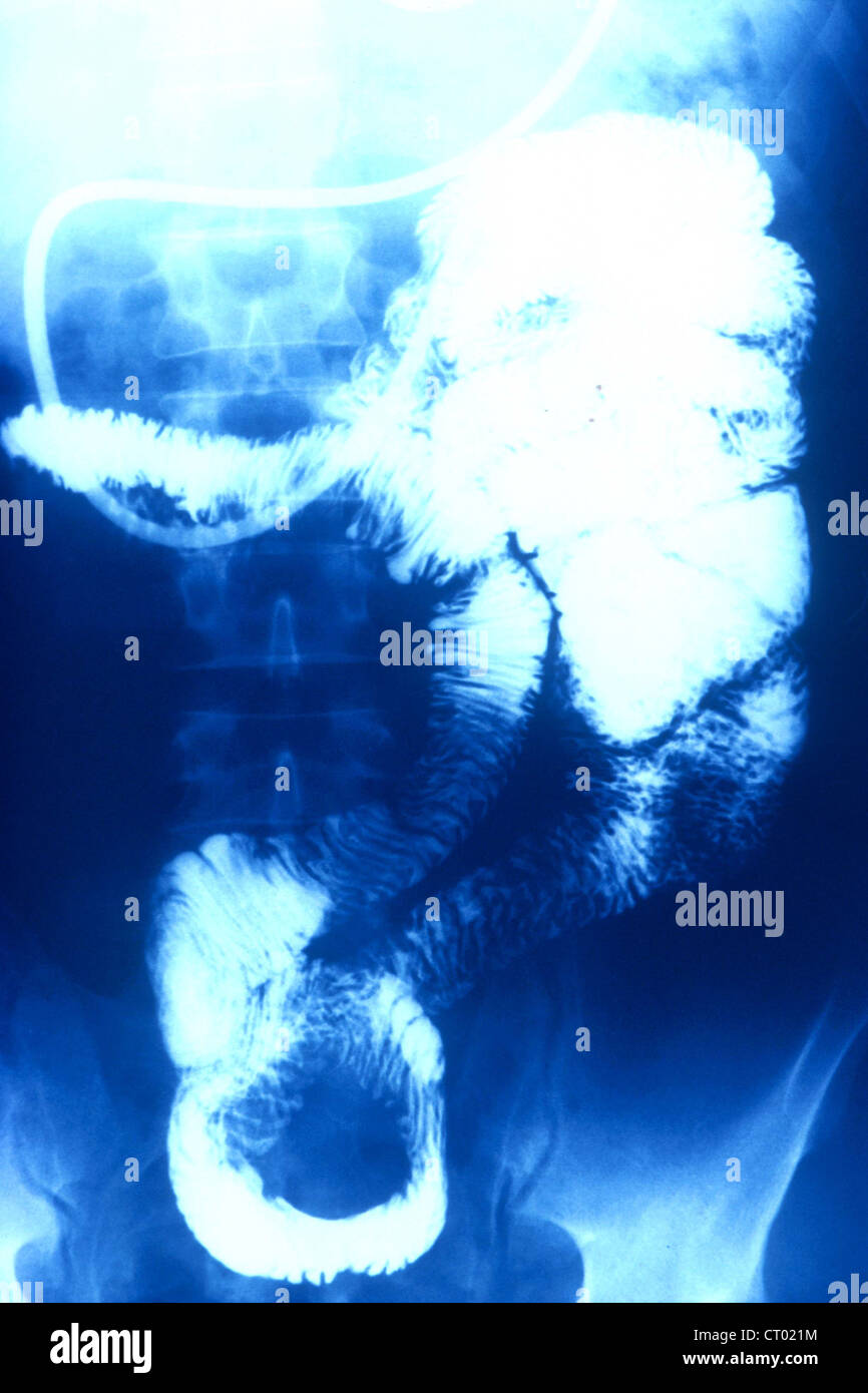 CANCER OF SMALL INTESTINE, X-RAY Stock Photo - Alamy