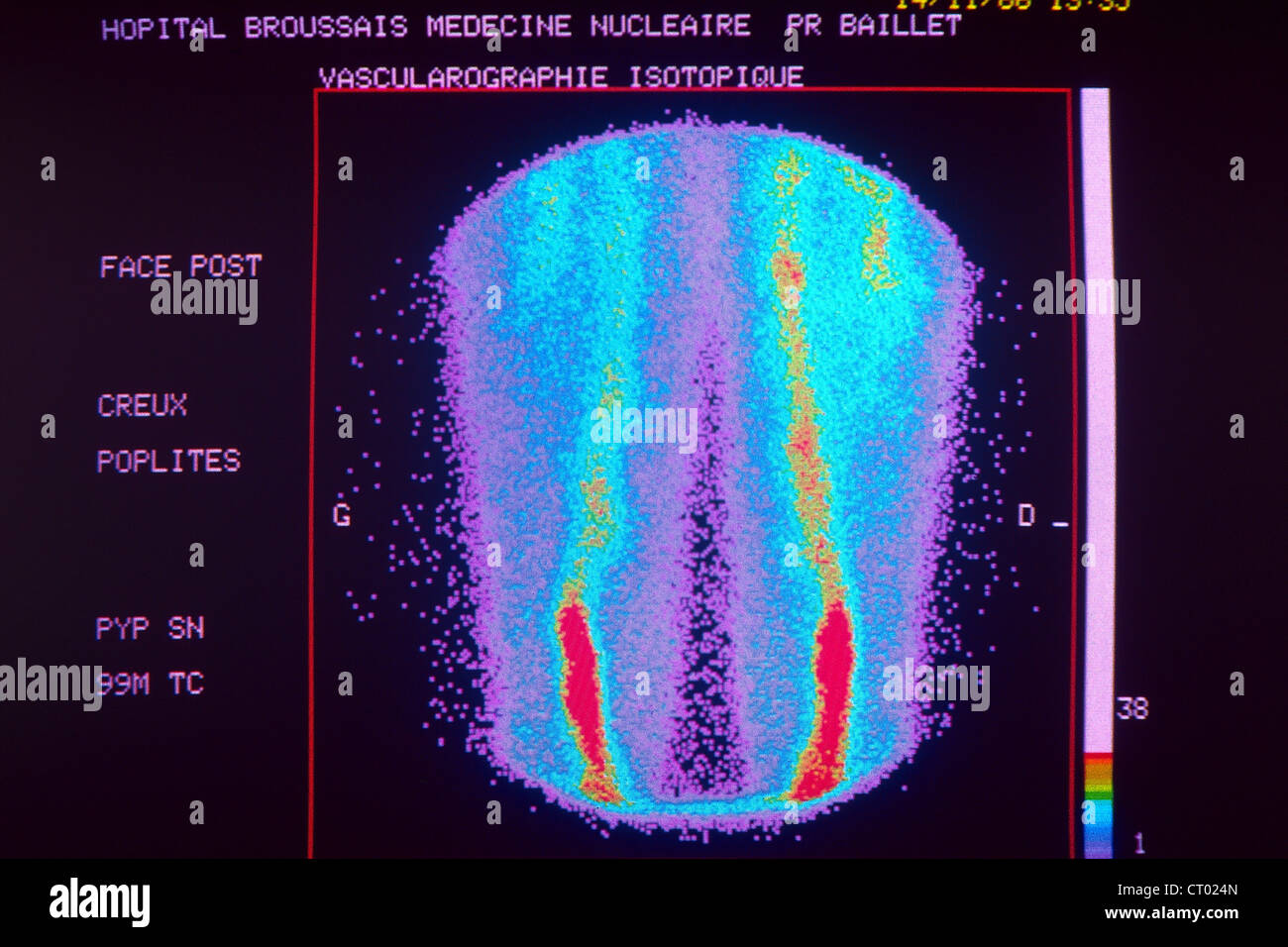 Phlebitis High Resolution Stock Photography and Images - Alamy