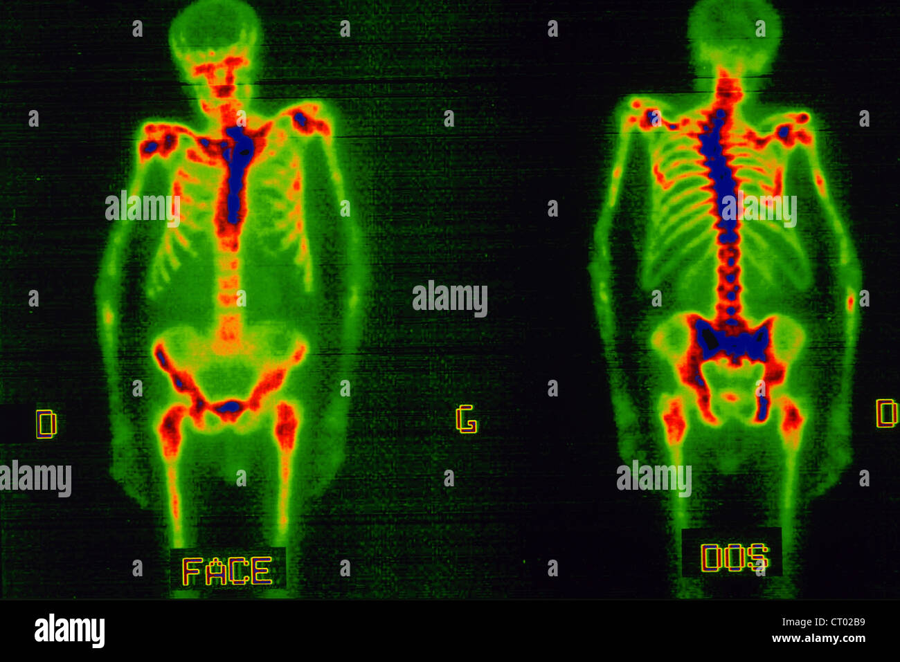 Scintiscanning hi-res stock photography and images - Alamy