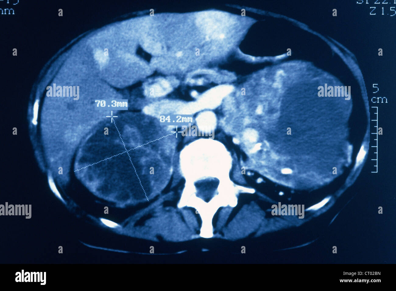 CANCER OF THE KIDNEY, SCAN Stock Photo - Alamy
