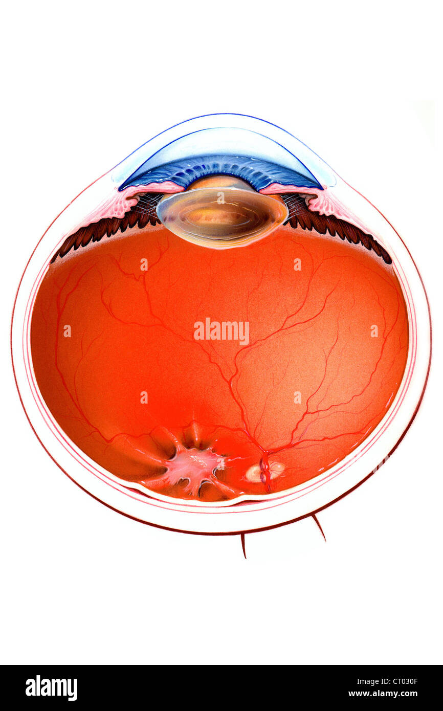 Retinal detachments hi-res stock photography and images - Alamy