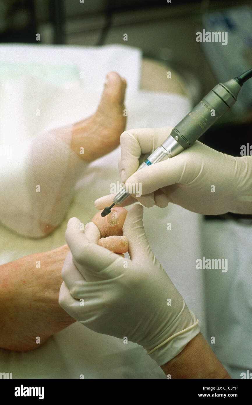 Angiitis hi-res stock photography and images - Alamy