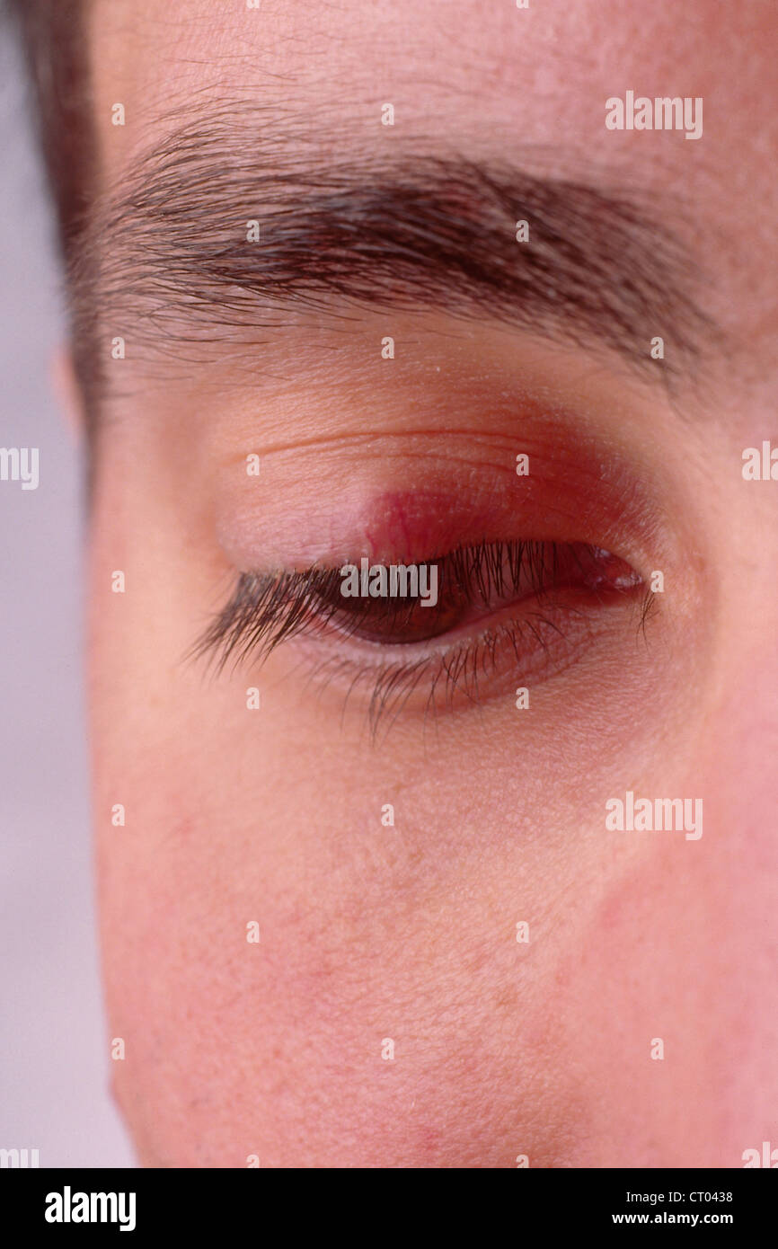 Stye eye hi-res stock photography and images - Alamy