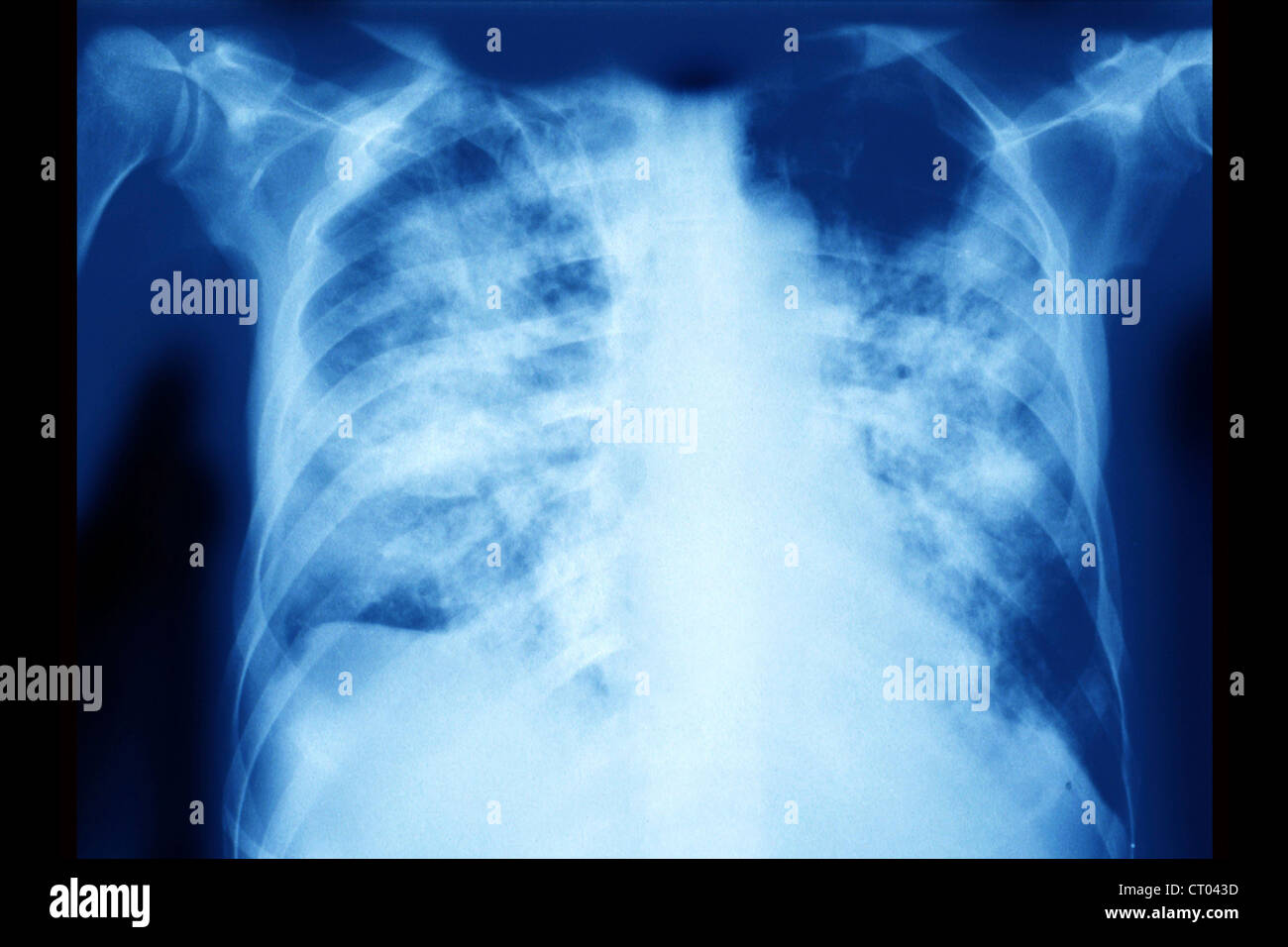 Aspergillosis hi-res stock photography and images - Alamy