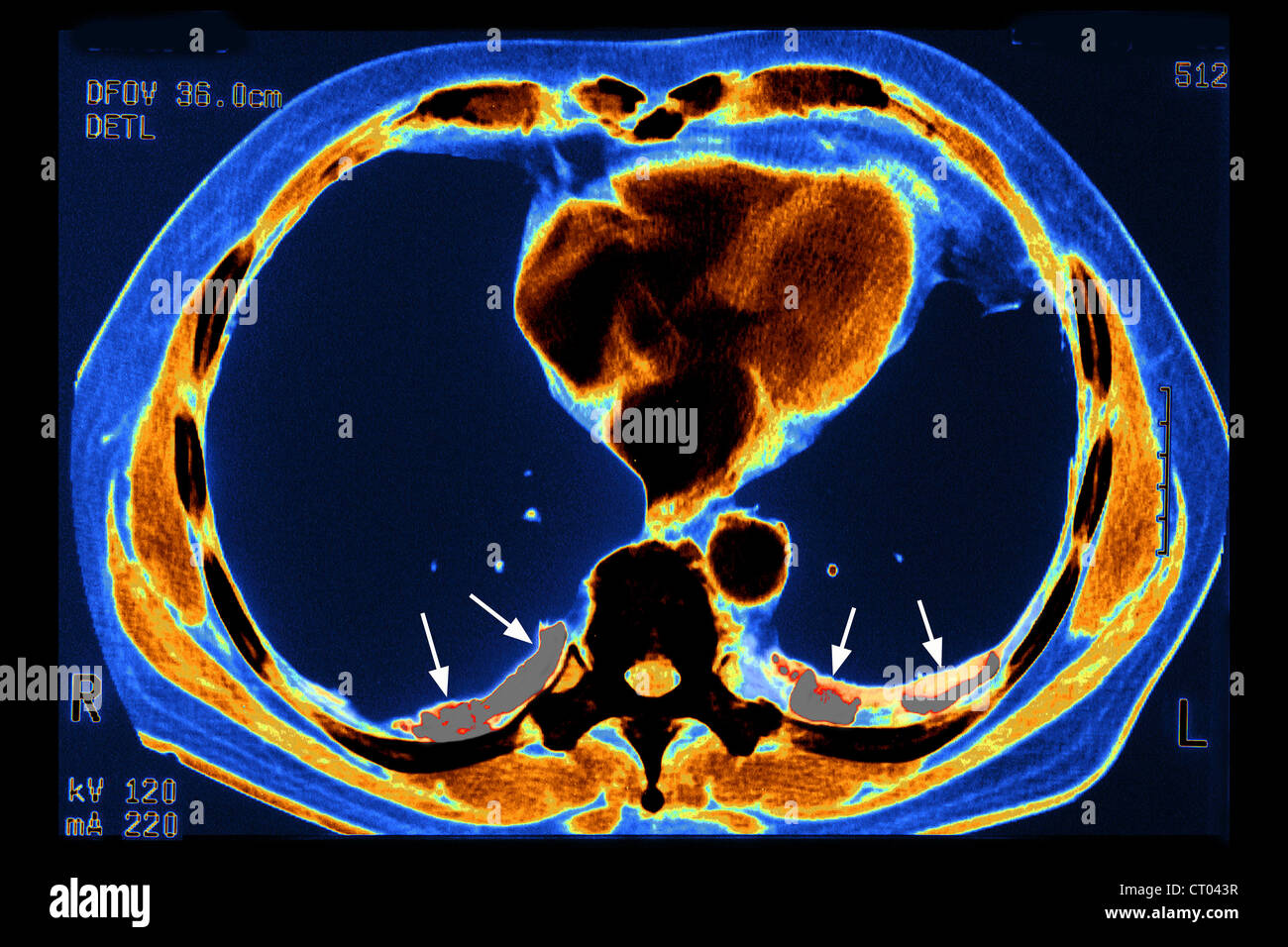 Pneumoconiosis hi-res stock photography and images - Alamy