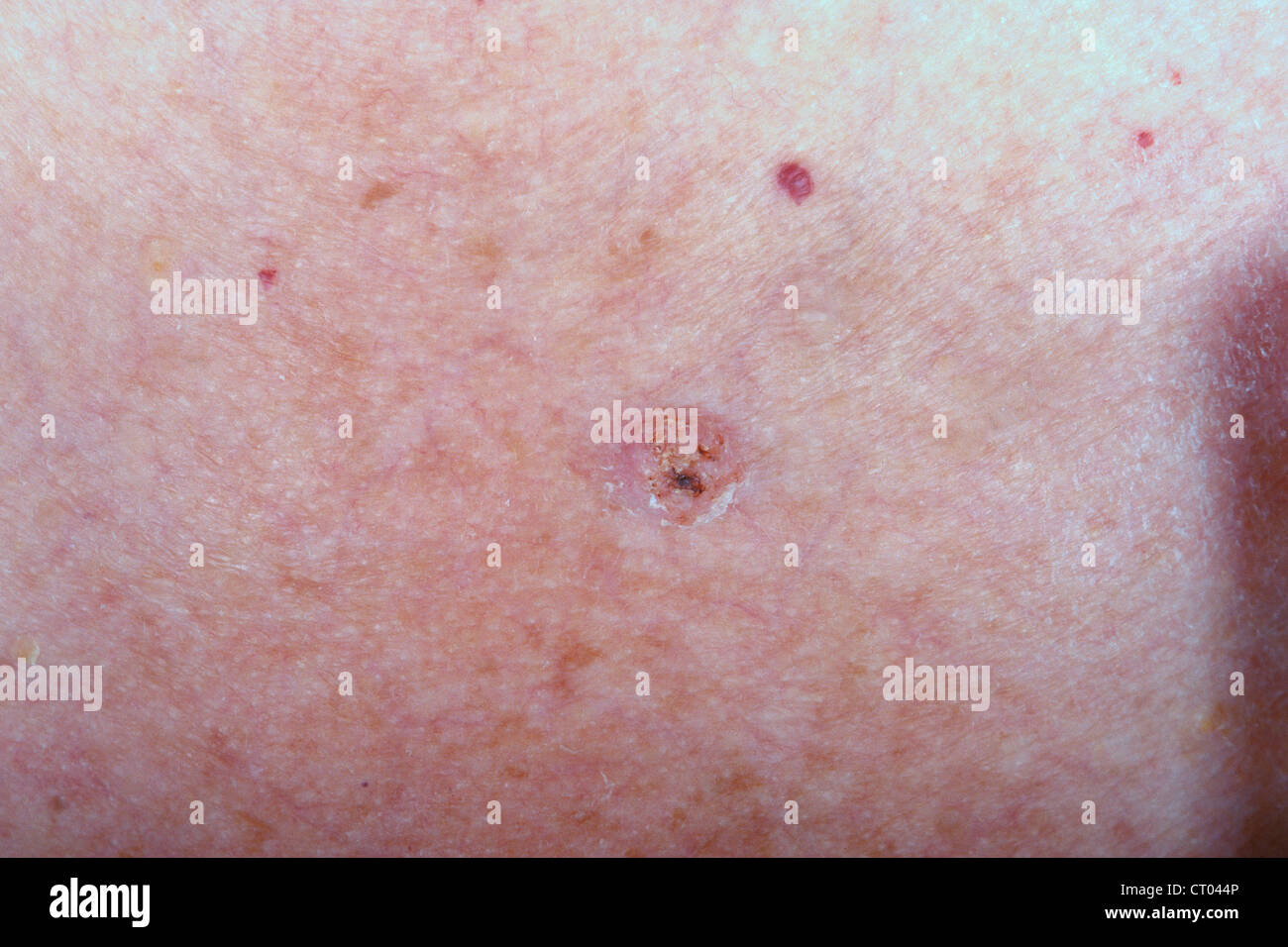 Skin nodule hi-res stock photography and images - Alamy