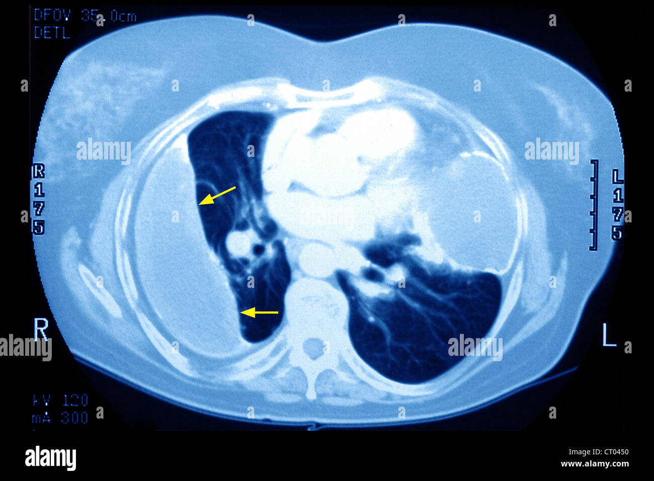 Pleurisy Of The Lung High Resolution Stock Photography and Images - Alamy