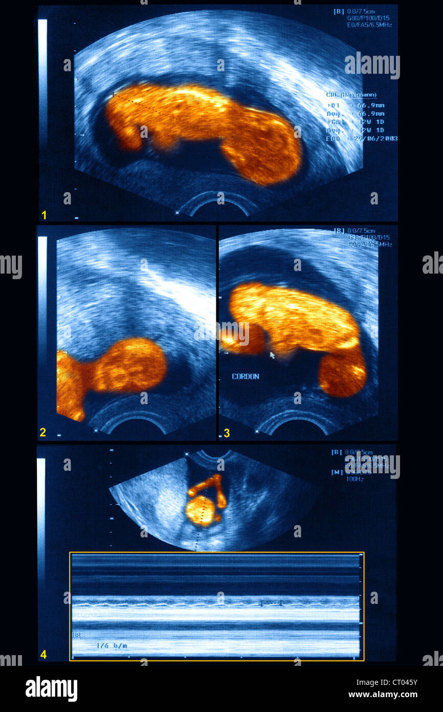 Fetal ultrasound hi-res stock photography and images - Alamy