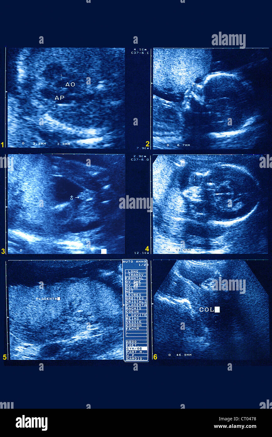 5 month ultrasound hi-res stock photography and images - Alamy