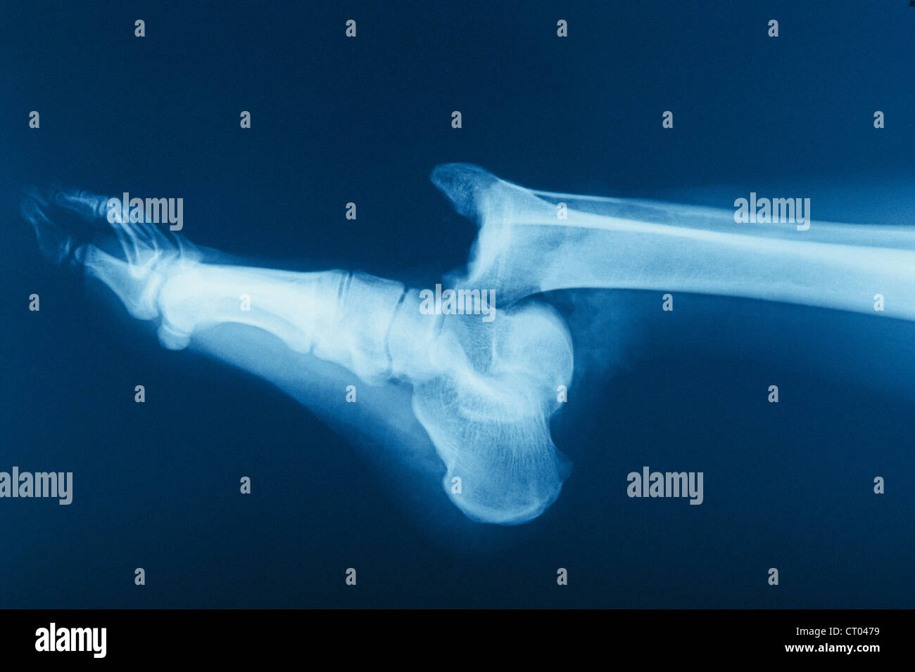 Tibia dislocation hi-res stock photography and images - Alamy