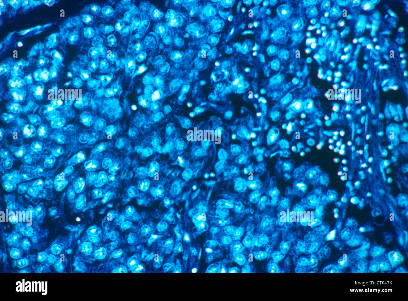 Testicular cancer histology hi-res stock photography and images - Alamy