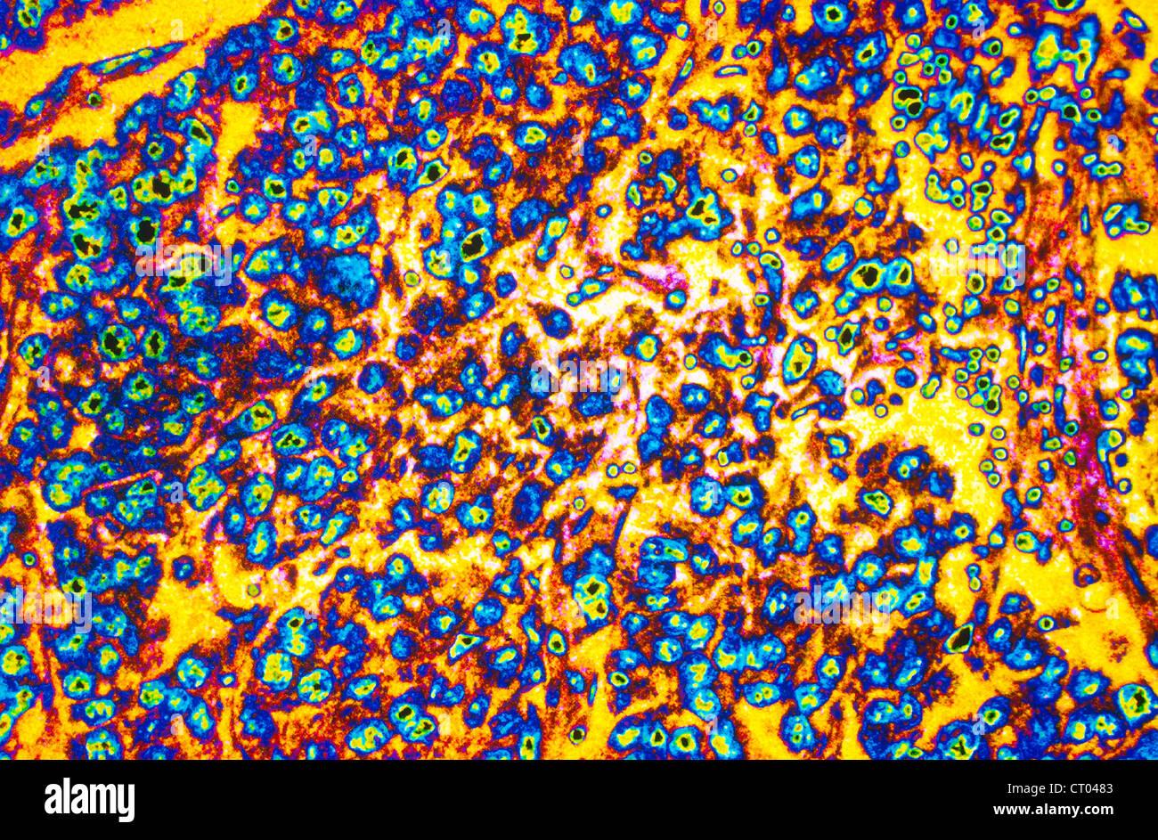 Testicular cancer histology hi-res stock photography and images - Alamy