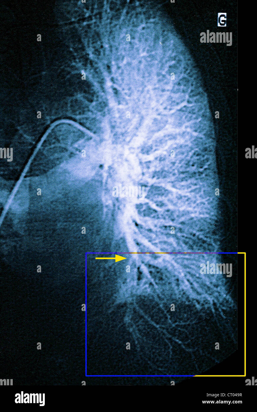 Pulmonary aspiration hi-res stock photography and images - Alamy