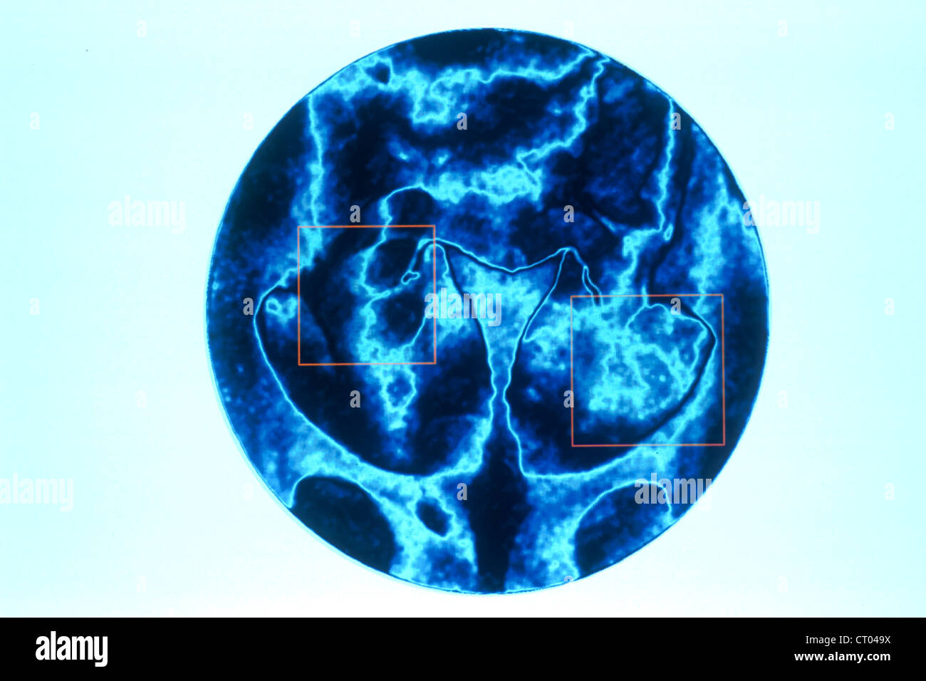 UTERINE TUBE OBSTRUCTION, X-RAY Stock Photo - Alamy