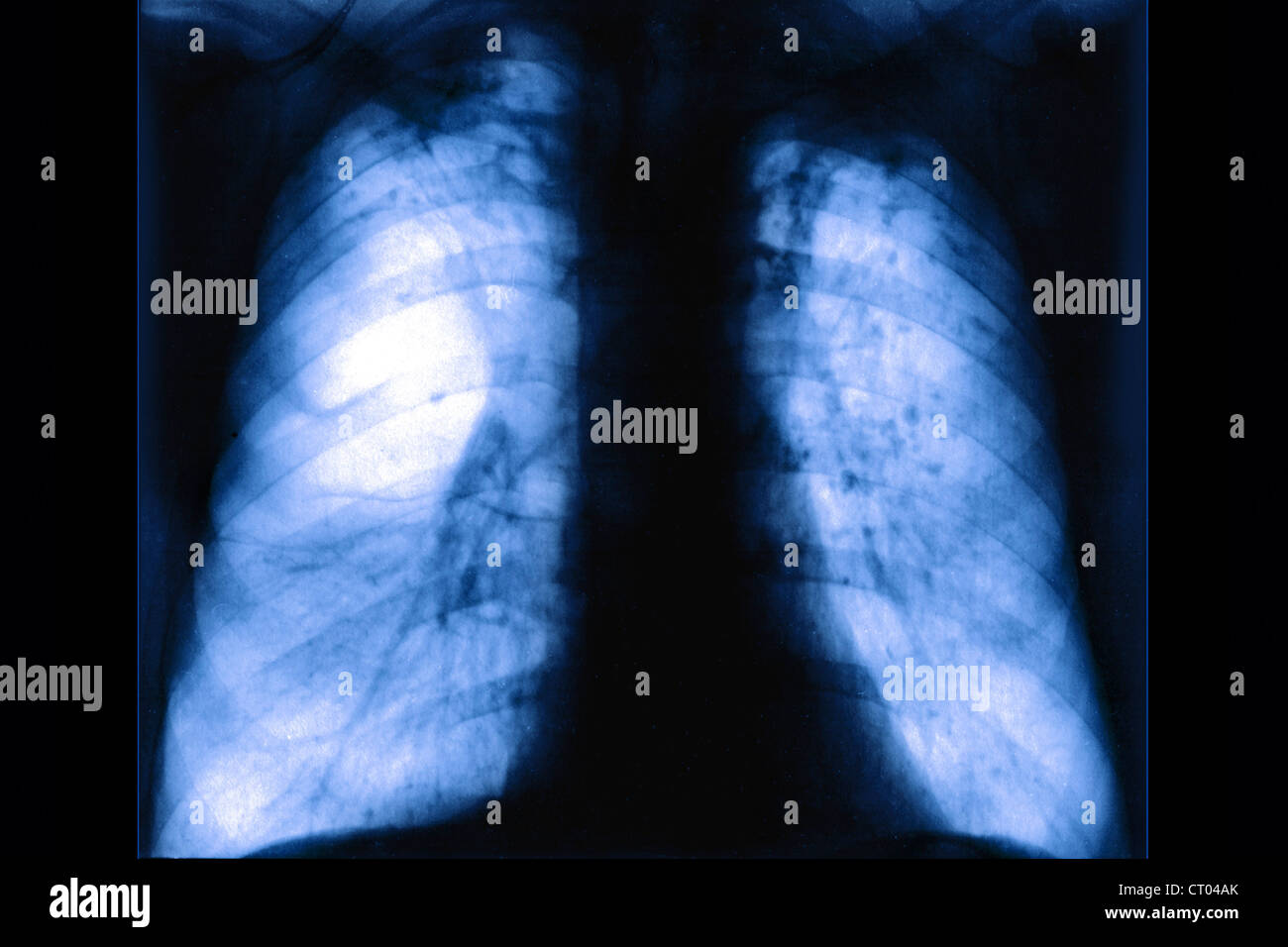 Emphysema Lung High Resolution Stock Photography and Images - Alamy